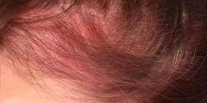 Methode Sensitive – Scalp Care